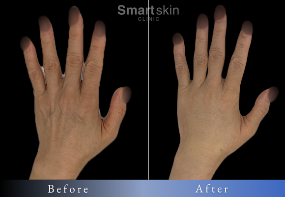 Personalized PRP Injection [Back of the hand and fingers] | Smart Skin ...